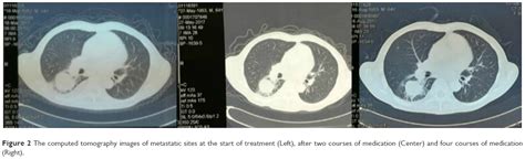 Apatinib Mesylate Tablet In The Treatment Of Advanced Malignant Melano