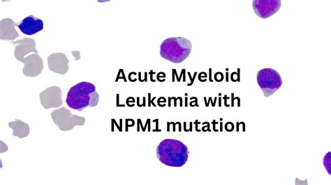 Acute Myeloid Leukemia With Npm1 Mutation Pathology Made Simple
