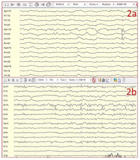 Figur 2a B Epileptiform Abnormalities On The Frontal Regions With Download Scientific Diagram