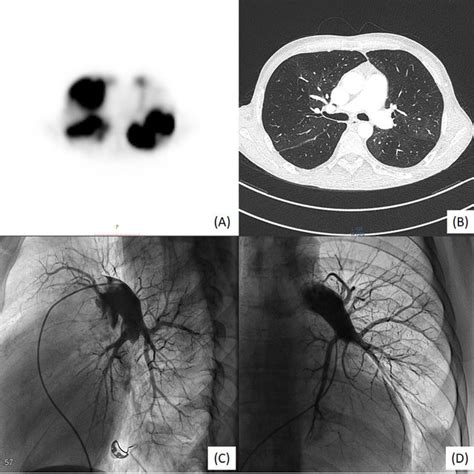 A V Q Scan Bilateral Perfusion Defects B MDCT Large Bilateral Download Scientific Diagram
