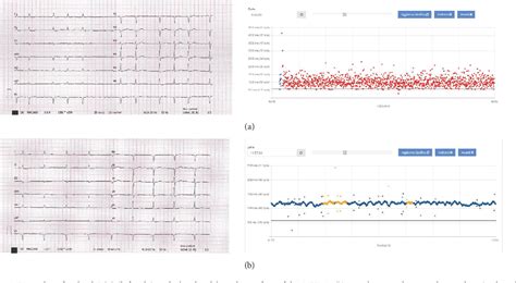 Figure 2 From The Ritmia™ Smartphone App For Automated Detection Of