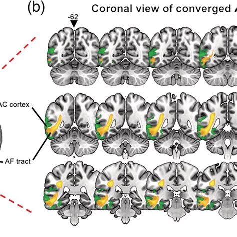 Converged Probabilistic Maps Of Auditory Comprehension Ac Cortex And