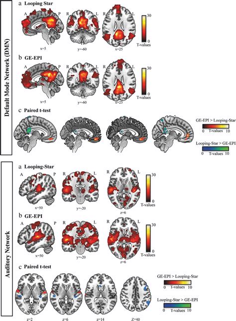 Results Of The Group Dmn Top And Auditory Bottom Seed Based Download Scientific Diagram