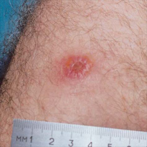Vaccine Scar