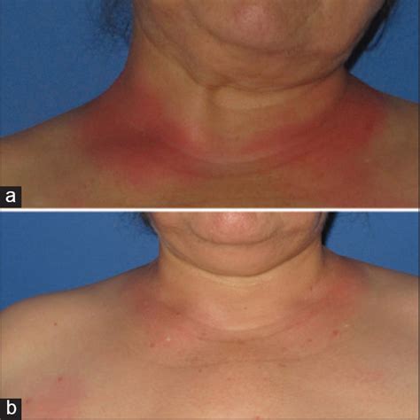 Indian Journal Of Dermatology Venereology And Leprology Symmetrical Drug Related