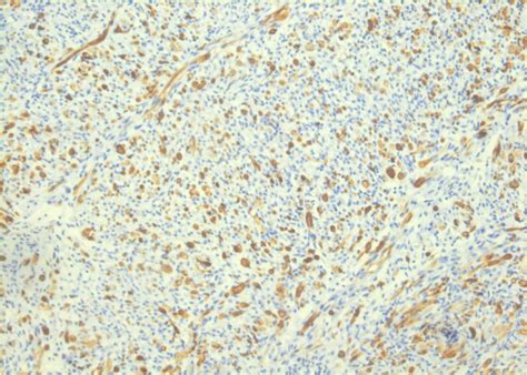Ihc X20 Expression Of Desmin By Tumor Cells Download Scientific Diagram