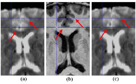 Sample Outcome Of The Non Rigid Registration Algorithm Locked Cursor Download Scientific