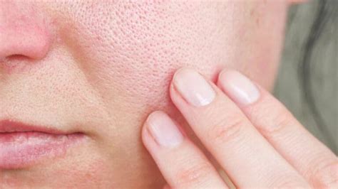 Dermatologists Reveal 10 Ways To Shrink Large Pores