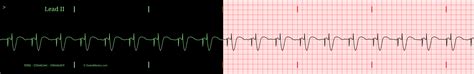 The Atrio Ventricular Pacemaker Ekgecg