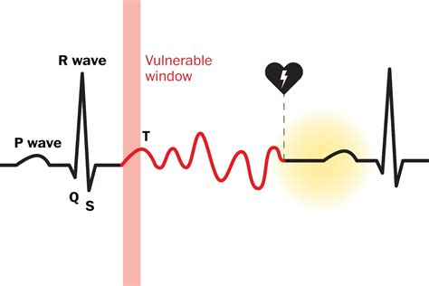Commotio Cordis Triggers Cardiac Arrest In Athletes But Risks Can Be Mitigated The Washington