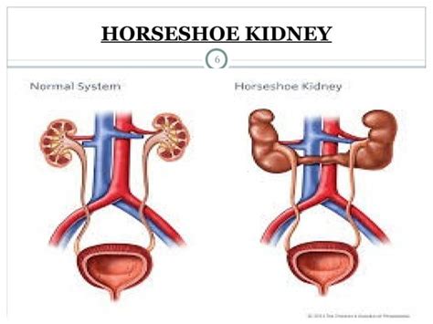 Diseases Of Excretory System Ppt