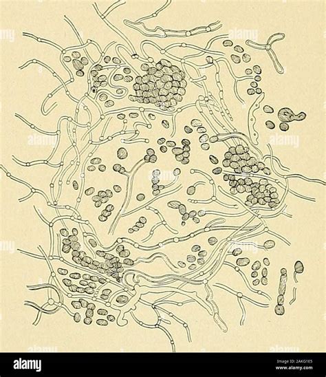 Tinea Versicolor Microscopic