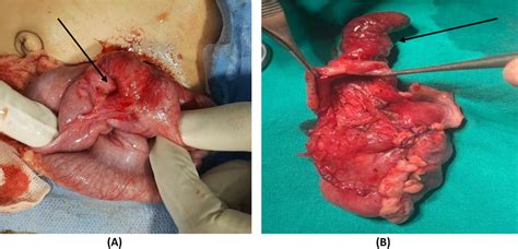 Ab Intraoperative Photo Showing The Appendiceal Intussusception
