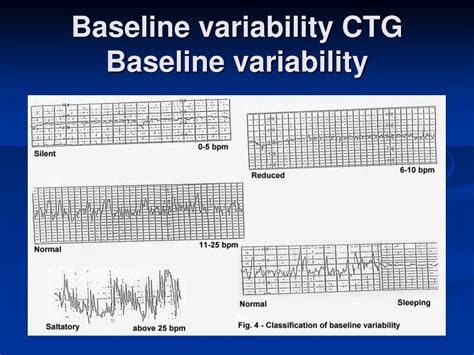 Types Of Ctg Monitoring At Sebastian Belbin Blog