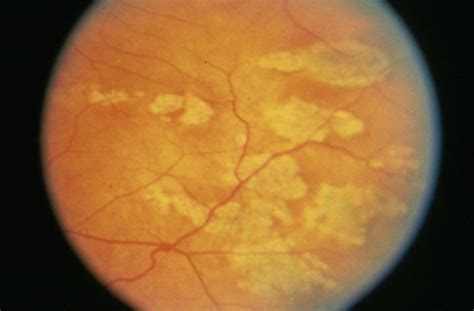 Hereditary Fundus Disorders Flashcards Quizlet