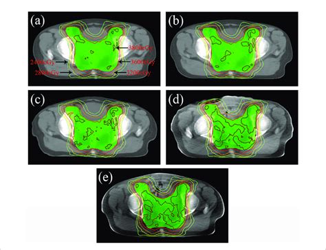 Dose Distribution Of Radiotherapy Plan Based On Four Ct Images At The Download Scientific