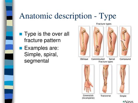 PPT Fracture Classification PowerPoint Presentation Free Download ID