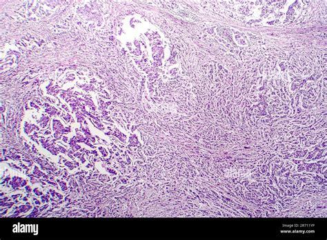 Lymph Node Cancer Light Micrograph Photo Under Microscope Stock Photo Alamy