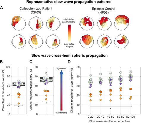 Integrity Of Corpus Callosum Is Essential For The Cross Hemispheric
