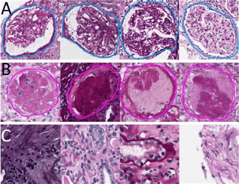 Examples Of Pas Stained Patches With Normal Glomeruli A Sclerosed Download Scientific