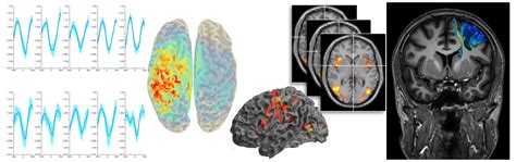 Effects Of Ageing On Inter Hemispheric Cross Talk Studying EEG FMRI And DTI In The Context