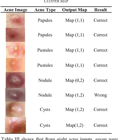 Figure From Acne Segmentation And Classification Using Region Growing