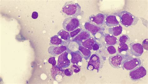 Rare Disease Day Get To Know About Sarcoma