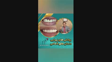 روکش های زیبایی دندان های قدامی نماشا