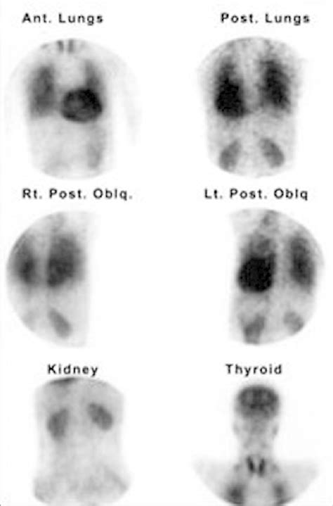 99technetium Macroaggregated Albumin Perfusion Imaging In A Patient Download Scientific Diagram