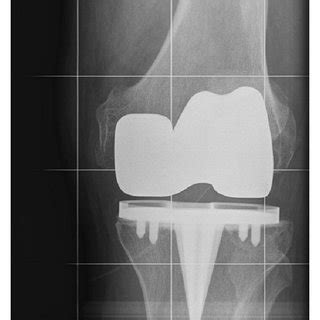 Anteroposterior Radiograph Of A Bilateral Tka Patient Implanted With