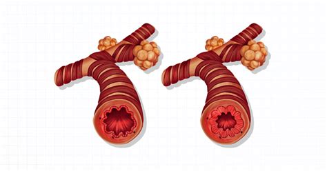 The 27 Early Warning Signs Of Copd To Look For 2024