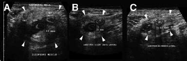 Inflamed Appendix In Unusual High Position In A Patient With Clinical Download Scientific