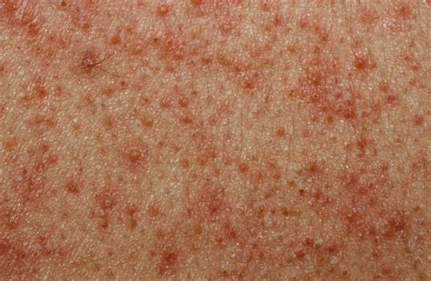 Keratosis Pilaris Causes Symptoms How To Get Rid Of It