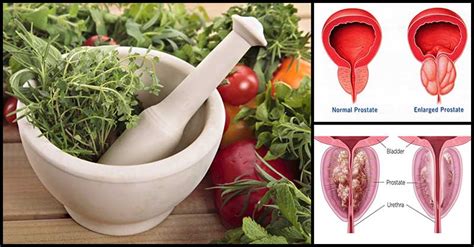 Herbal Remedies That Help Control Prostate Enlargement Dr Farrah Md