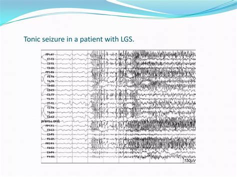 Epileptic Encephalopathy Eeg Ppt