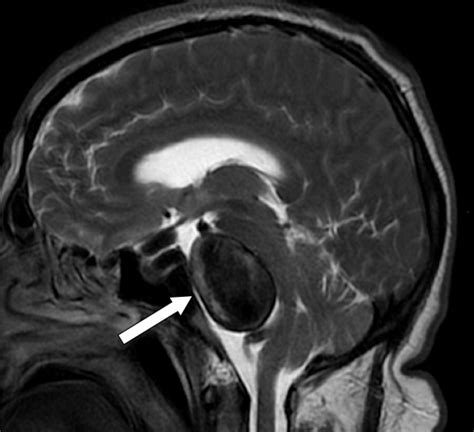 Basilar Artery Aneurysm Causes