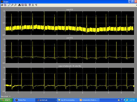 Shows Noisy Ecg Pure Ecg Output Of 4 Th Order Butterworth Filter