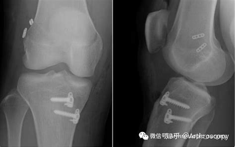 手术技术｜前交叉重建术后如何巧取带袢钢板！ 知乎