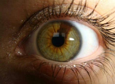 Sectoral Hetrochromia Eye Color Green Eyes Sectoral Heterochromia