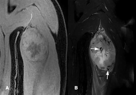 Preoperative Mri Of An Alveolar Soft Part Sarcoma In The Triceps Download Scientific Diagram