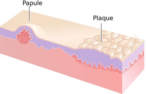 Difference Between Acne And Pimple Clinical Features Causes Management And Treatment