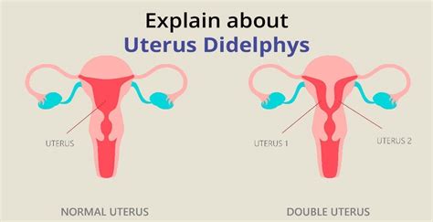 Uterus Didelphys Causes Symptoms Diagnosis Treatment 45 Off