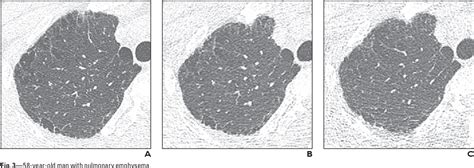 Figure 1 From Ultra Low Dose Ct Of The Thorax Using Iterative Reconstruction Evaluation Of