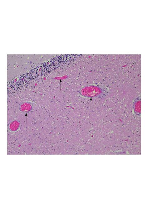 Erythrocyte Aggregation With Sludge” Phenomenon Arrows In The
