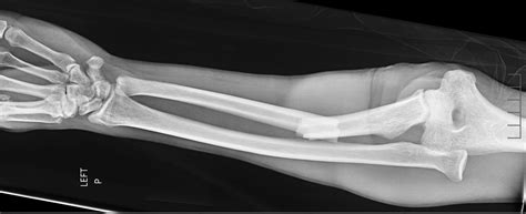 Monteggia Fracture Meded Cases