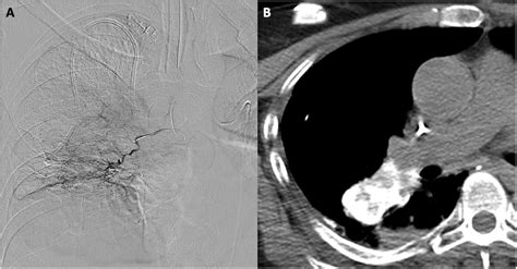 Bronchial Artery Chemoembolization In A 65 Year Old Woman With Download Scientific Diagram