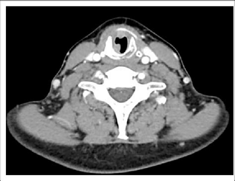 Computed Tomography Ct Axial Section Stenosis In The Subglottic