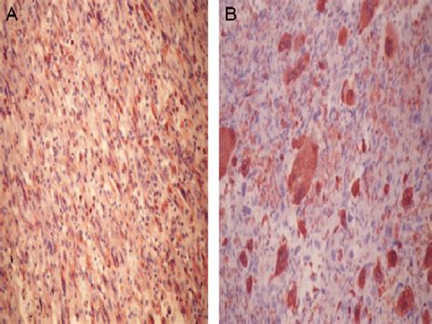 Epithelioid and spindle cells of GIST were positive for c kit CD Â Download Scientific
