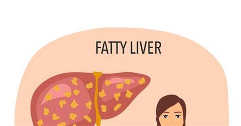 대사이상 지방간 있으면 간암 위험 4 7배