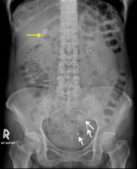 Acute Appendicitis Radiology Cases